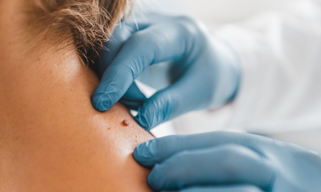 Skin Cancer Specialist in St. Michaels - Cronin Dermatology