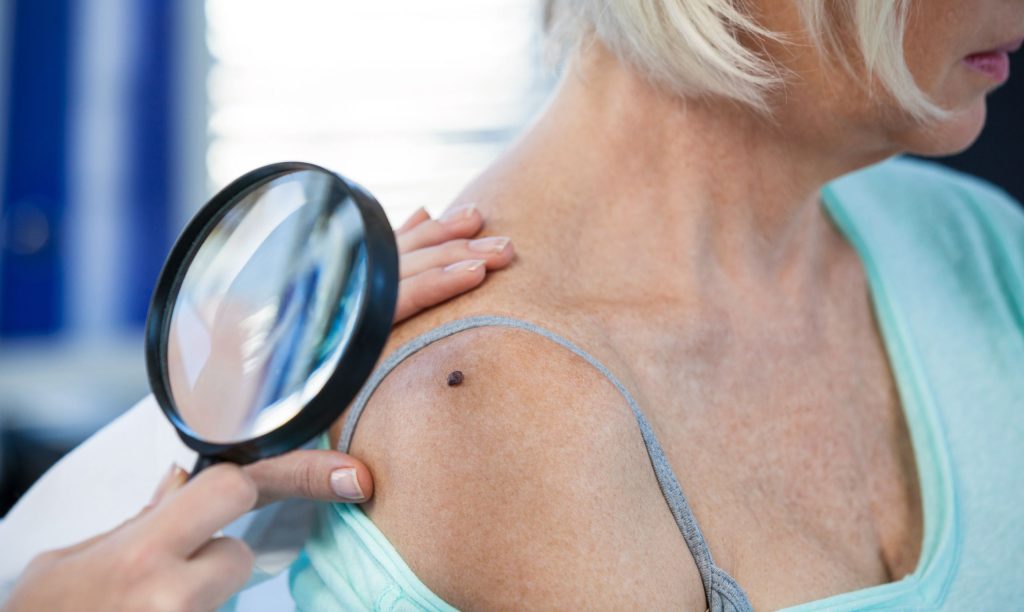 Blue Light Treatments Annapolis – Top Skin Cancer Prevention - Cronin ...