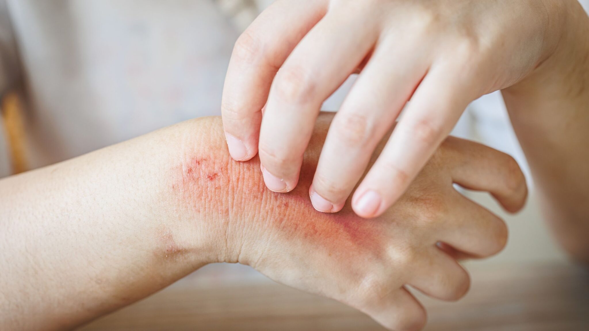 Contact Dermatitis Treatment Eastern Shore: Say Goodbye to Angry Skin ...